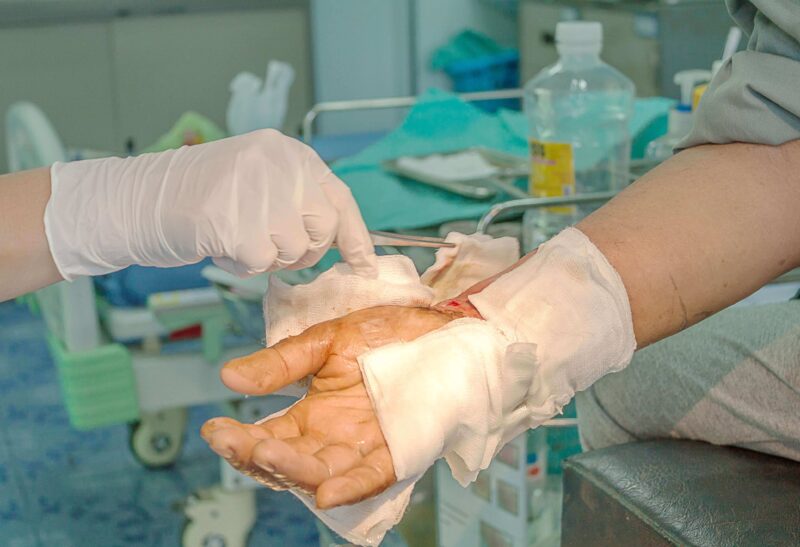 Burn Wound Care: How to Treat Burns Safely - West Coast Wound & Skin Care