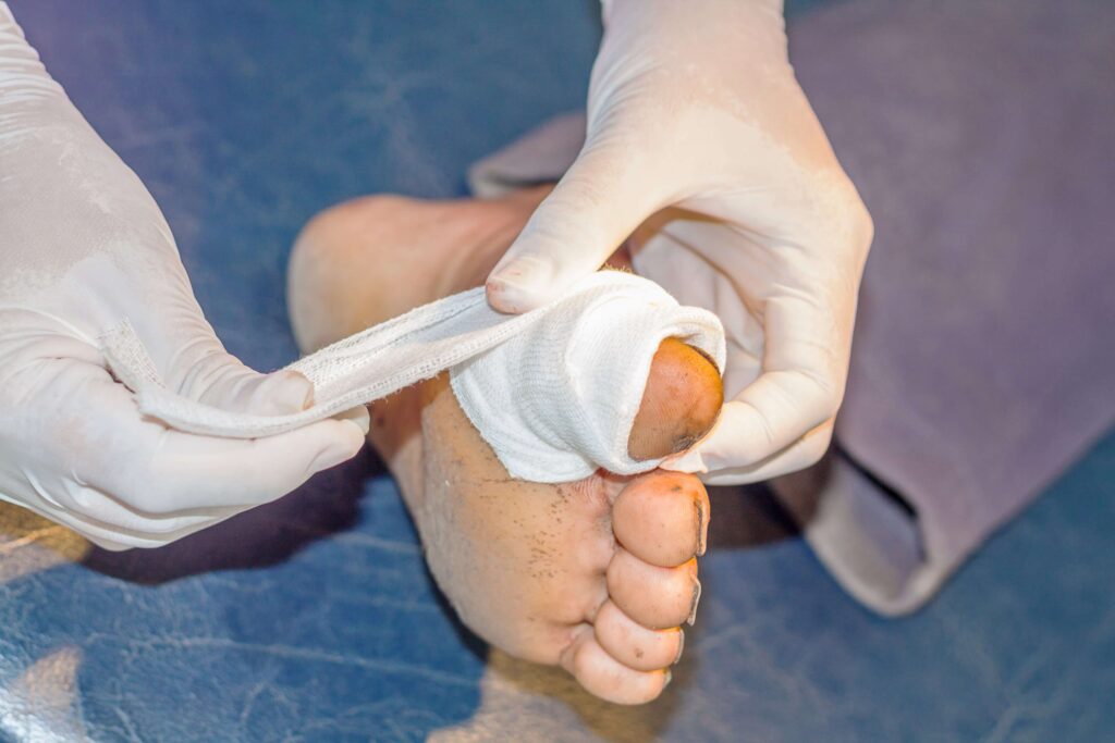 Arterial Ulcer Treatment, Management and Wound Care