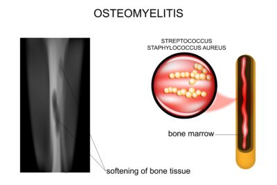 What is Osteomyelitis, What Causes It and How is it Treated?