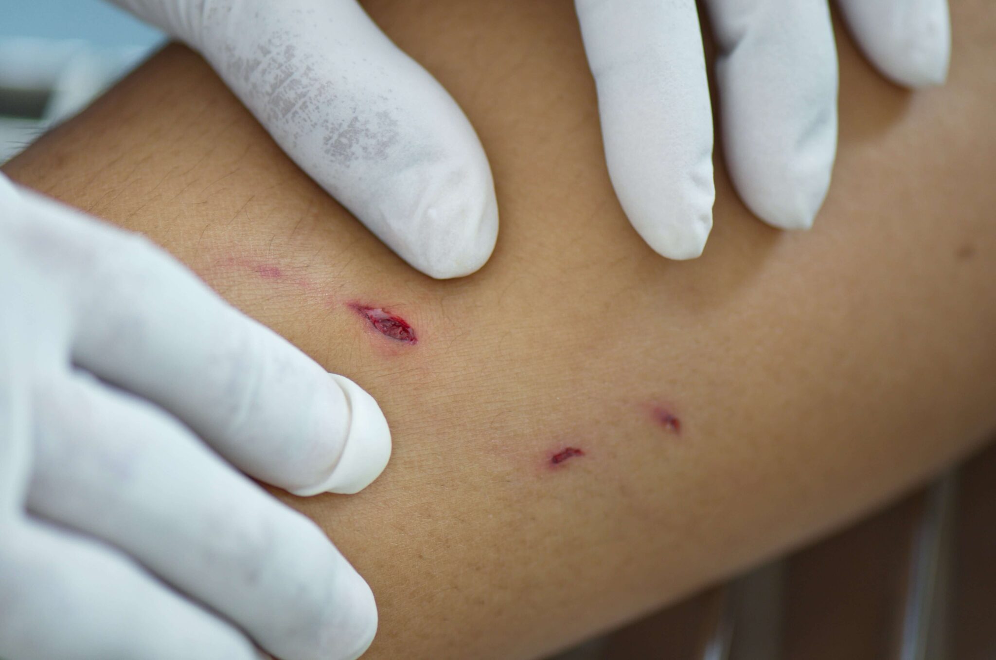 Wound Care and Treatment After a Dog or Animal Bite