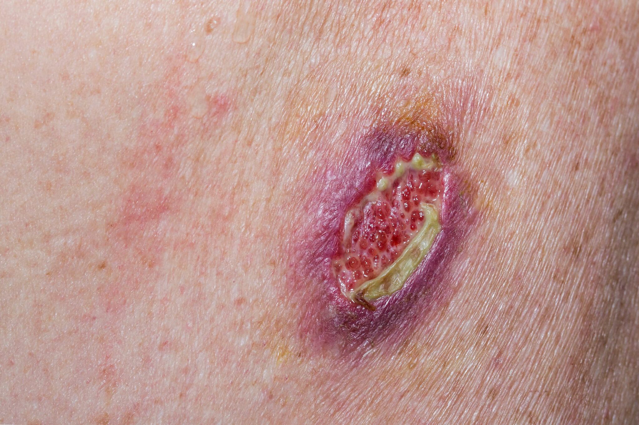What is Wound Dehiscence and How Is It Treated?