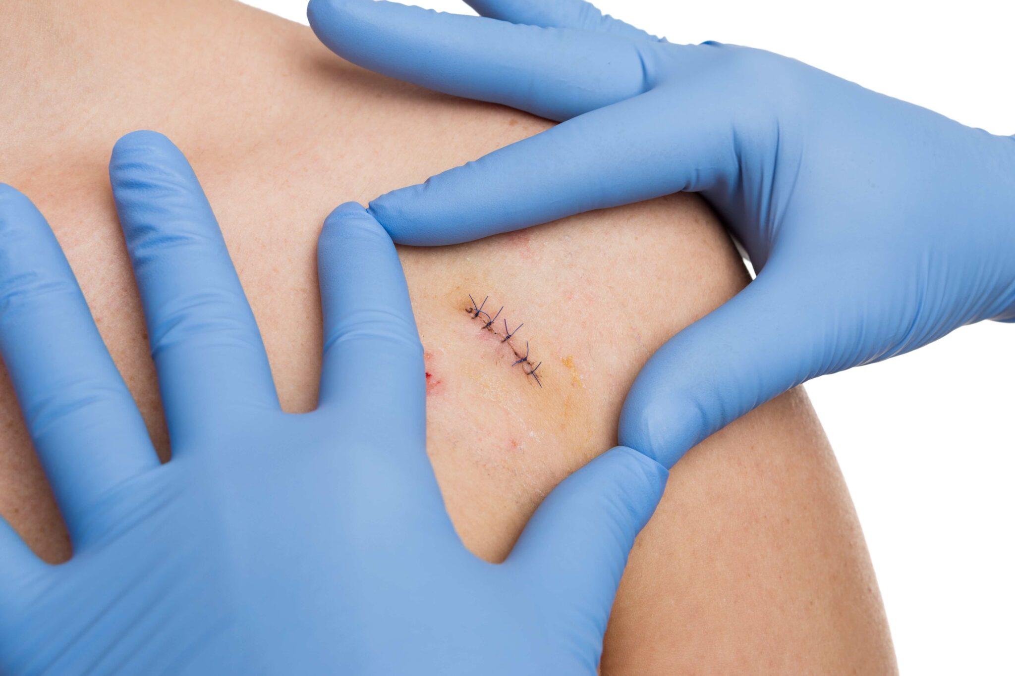 A Guide to Stitches, Staples and Sutures in Wound Care