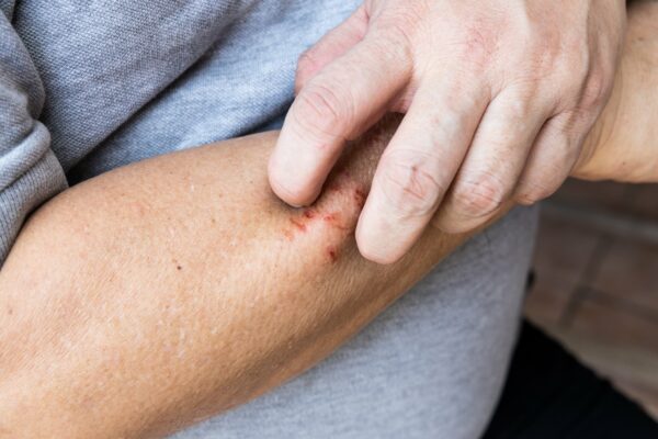 Why Wounds Itch During Healing and How to Stop It