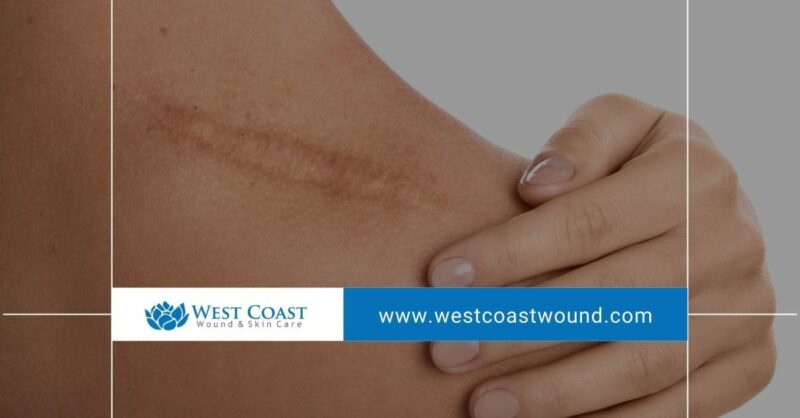 wound care in Houston: Malodor Treatment Guide - West Coast Wound ...